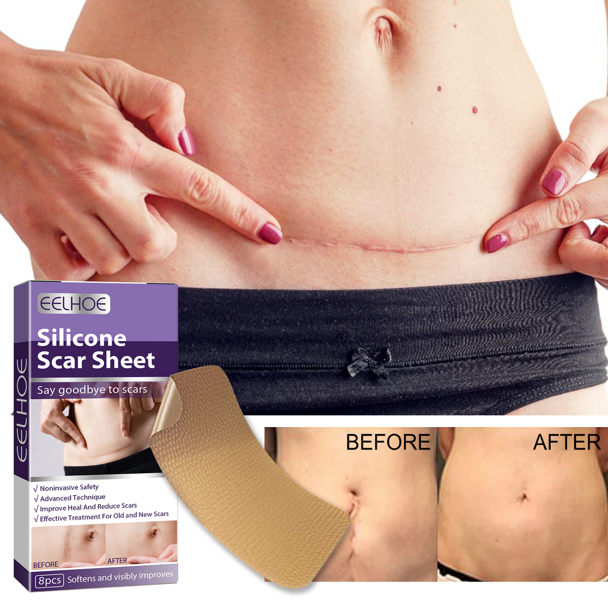 Silicone Scar Patch, Reduces Stretch Marks And Hyperplasia Of Caesarean ...
